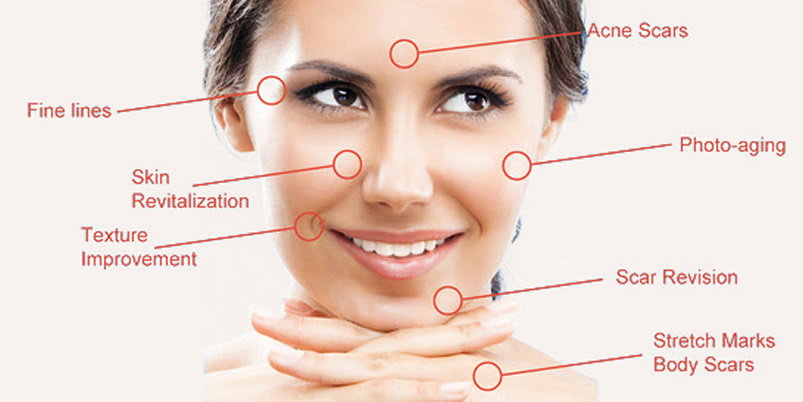Collagen Induction Treatment with Micro-Needling and PRP - Rejuvenation MD Collagen Induction Treatment with Micro-Needling and PRP - Rejuvenation MD